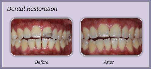 restoration-before-after | Family Care Dental Group